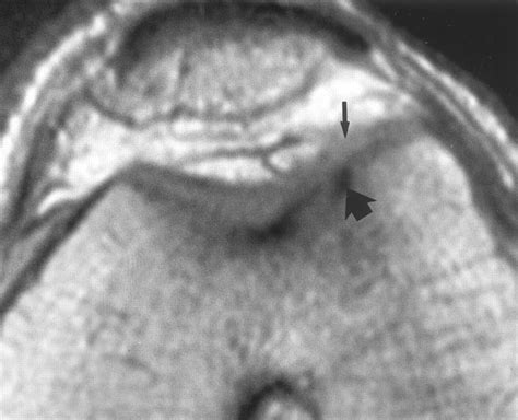 Grading Articular Cartilage Of The Knee Using Fast Spin Echo Proton