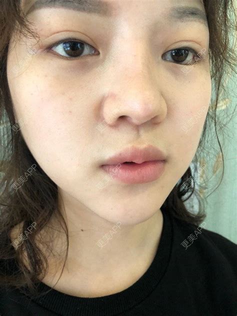 厚唇改薄整形图片 整形m唇图片 大山谷图库