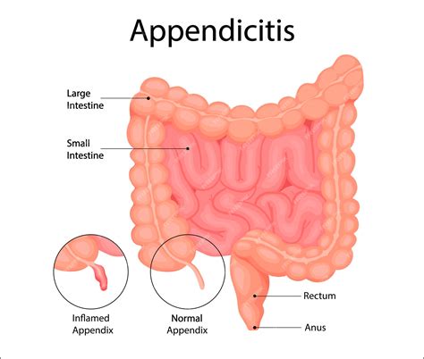 Appendix Inflammation