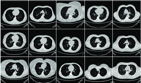 Raw Control Ct Slices Images Taken From Novmed Dataset Download