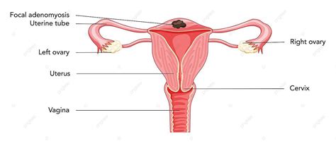 Annotated Illustration Focal Adenomyosis In The Female Reproductive System Featuring Uterus And