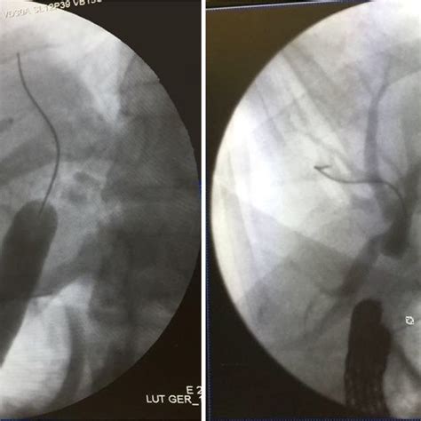 Pdf Transjejunal Laparoscopic Assisted Ercp In A Patient With Roux En Y Hepaticojejunostomy