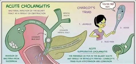 Acute Cholangitis Medical School Stuff Nursing Mnemonics Medical Knowledge