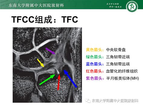 腕关节三角纤维软骨复合体（tfcc）解剖及创伤性损伤的影像表现 好医术文章 好医术 赋能医生守护生命