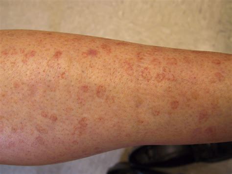 Red Blotchy Marks On Legs Senile Purpura Causes Symptoms And