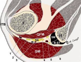 Deep Gluteal Syndrome Anatomy Imaging And Management Of Sciatic