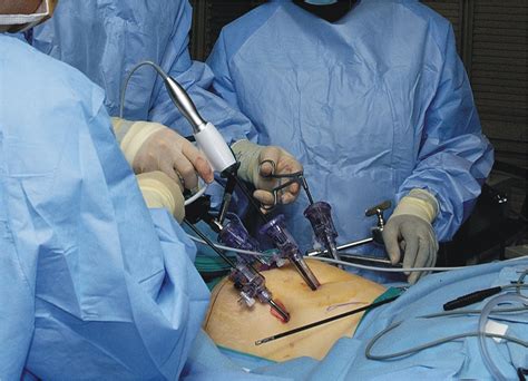 Appendectomy With Endoloop At Randy Arndt Blog