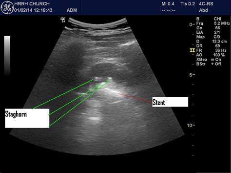 Staghorn Calculus Ede Blog