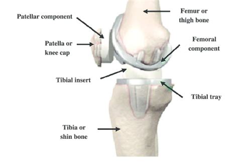The Components Of A Total Knee Replacement Download Scientific Diagram