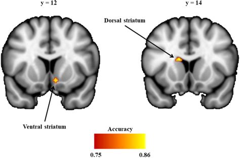 Ventral Striatum Fmri