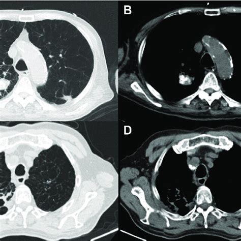 Chest Ct Scans Of Tuberculosis Sequelae In Two Copd Patients With A