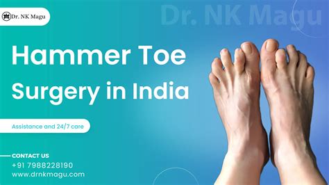 Hammer Toe Surgery Cost In India Dr Nk Magu