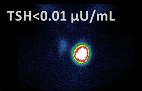 Rfa Event Ablation Technique For Autonomously Functioning Thyroid Nodules