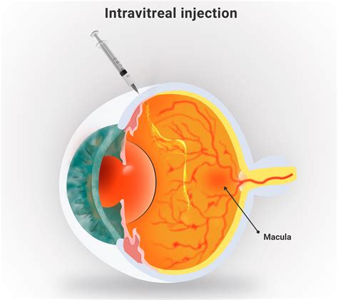 Three Cases Of Severe Eye Inflammation Occur After Vabysmo Injection Report Johns Hopkins
