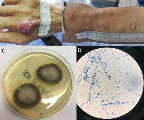 Subcutaneous Nodules