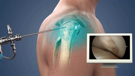 Arthroscopic Shoulder Synovectomy Hip Knee Shoulder Surgeon