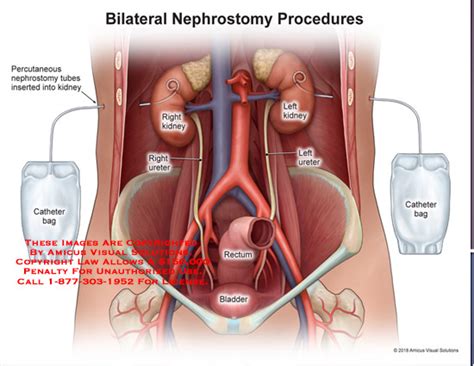 Bilateral Nephrostomy Procedures