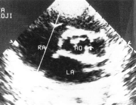 Figure 1 From Allograft Aortic Root Replacement For Aortic Valve