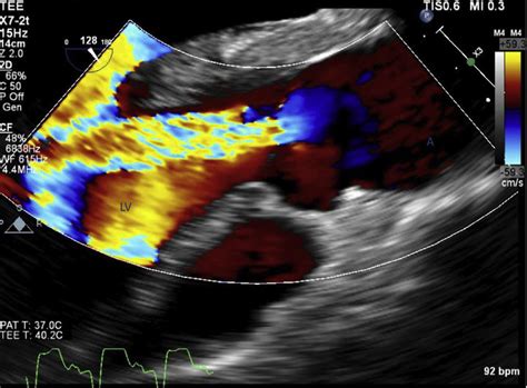 Long Axis Tee View With Color Doppler Showing Moderate Aortic
