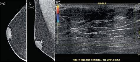 A C Full Field Digital Mammographic Cc A And Mlo B Views Of The Download Scientific