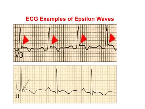 Epsilon Wave In Ecg And Its Interpretation Pptx