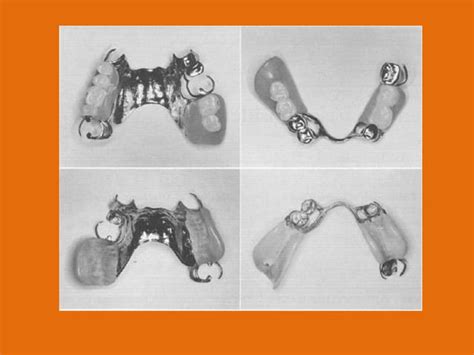 1659908partial Denture Classification Ppt