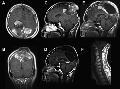 Intracranial Infiltration By Recurrent Scalp Dermatofibrosarcoma Protuberans Journal Of