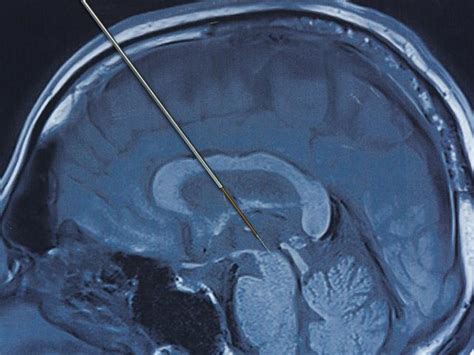 Intracranial Recordings And Electroencephalography The Oehrn Lab