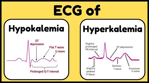 Hypokalemia Signs And Symptoms Ecg