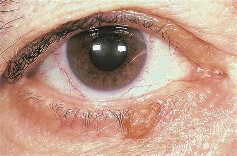 Lid Lesions Laster Eye Center