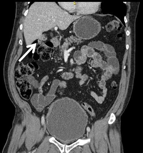Shows An Area Of Inflammatory Reaction Between The Hepatic Flexure And Download Scientific
