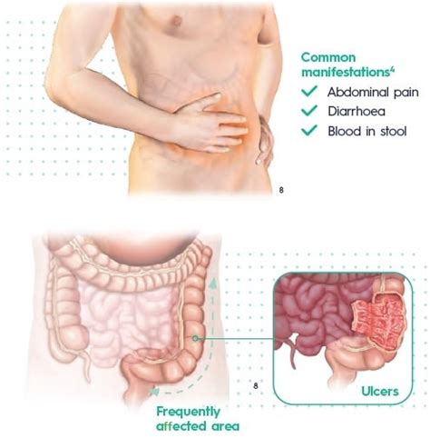 Ulcerative Colitis Articles Dis Chem