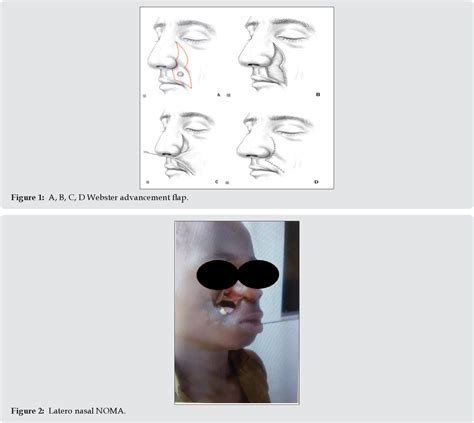 Figure 1 From Correction Of A Latero Nasal Cancrum Oris Defect Using