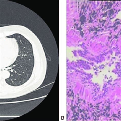 A 60 Year Old Nonsmoking Woman With A Peripheral Solid Nodule In The Download Scientific