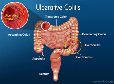 What Is Ulcerative Colitis Symptoms Causes Diagnosis Treatment