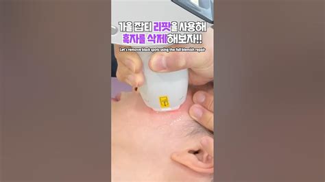 가을에는 흑자치료 리팟레이저로 삭제 일산리팟 화정피부과 Youtube