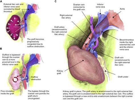 Schematic Drawing Depicts The Steps Of Gonadal Vein Utilization To
