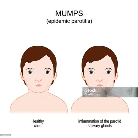 Mumps Epidemic Parotitis Viral Disease Stock Illustration Download