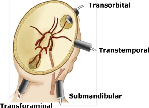 Figure 11 From Ultrasound Based Non Invasive Intracranial Pressure Semantic Scholar