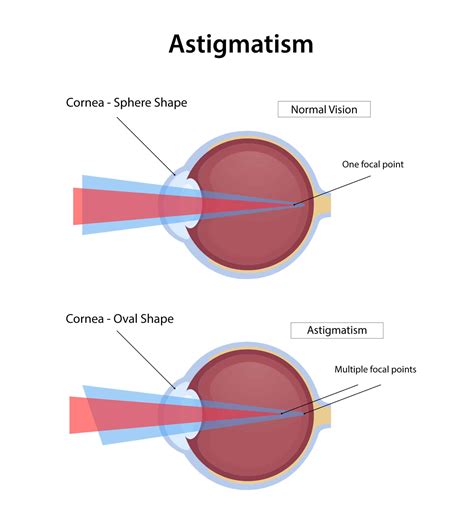 Astigmatism Vs Lazy Eye How They Differ And Why It Matters Precision