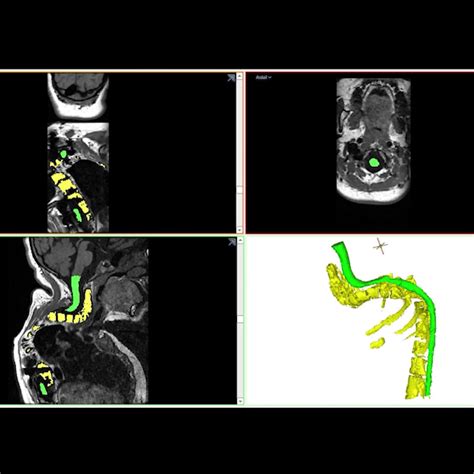 Idiopathic Scoliosis 3d And Quantitative Imaging Laboratory