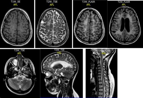 Flvcr1 Gene Mutation In A Patient With An Atypical Multiple Sclerosis Like Presentation