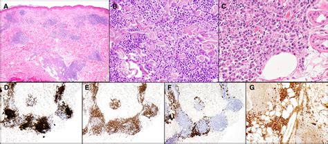 The Majority Of Primary Cutaneous Marginal Zone Lymphoproliferative Download Scientific Diagram