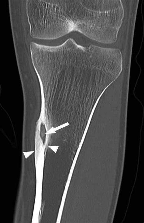 Periosteal Reaction Ajr Periosteal Reaction Ajr