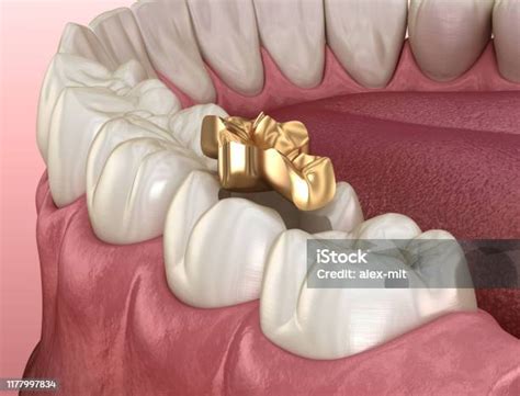 치아 위에 황금 인레이 크라운 고정 인간의 치아 치료의 의학적으로 정확한 3d 그림 상감 세공에 대한 스톡 사진 및 기타 이미지 상감 세공 이빨 0명 Istock
