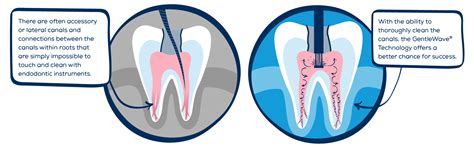Understanding Your Root Canal Procedure Ask A Root Canal Specialist