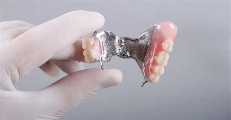 Cobalt Chrome Dentures From £125 Pm 0