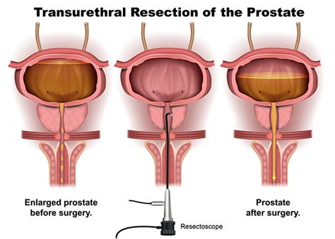 Transurethral Resection Of The Prostate