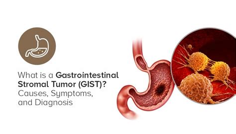 Gist Tumor Causes Symptoms And Gastrointestinal Diagnosis