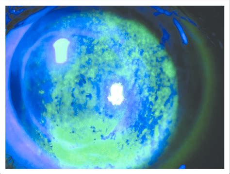 Extensive Superficial Punctate Staining This Could Be Caused By Download Scientific Diagram